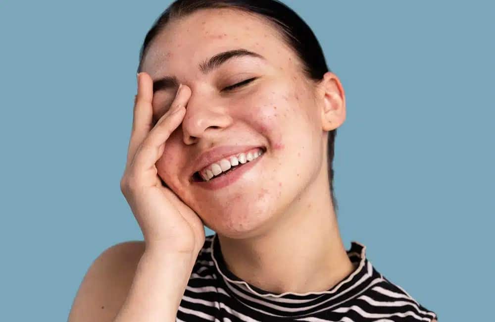 Products for Melasma on Face Treatment - Maysdermatology